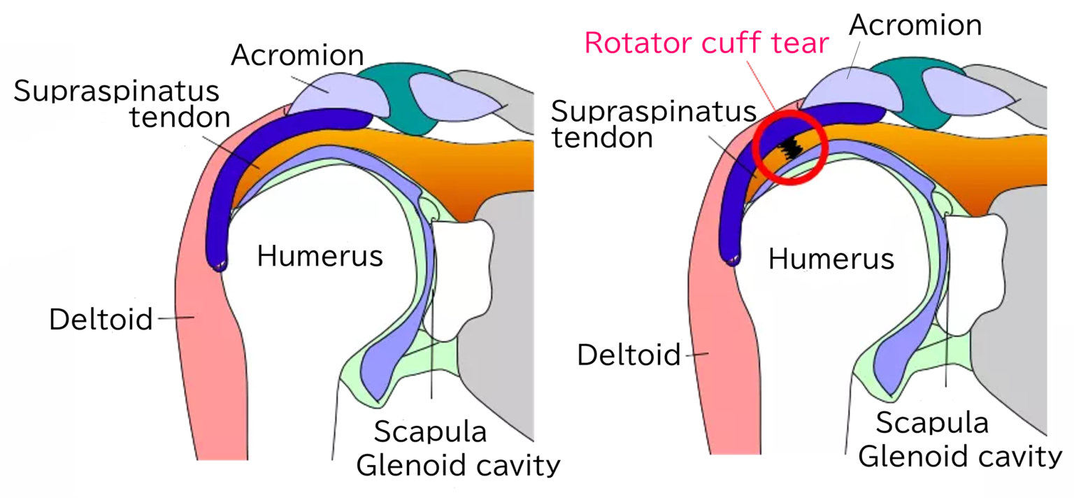 ROTATOR CUFF TEAR OR INJURY | MEDICAL INFO | Kyoto Shoulder & Sports Clinic