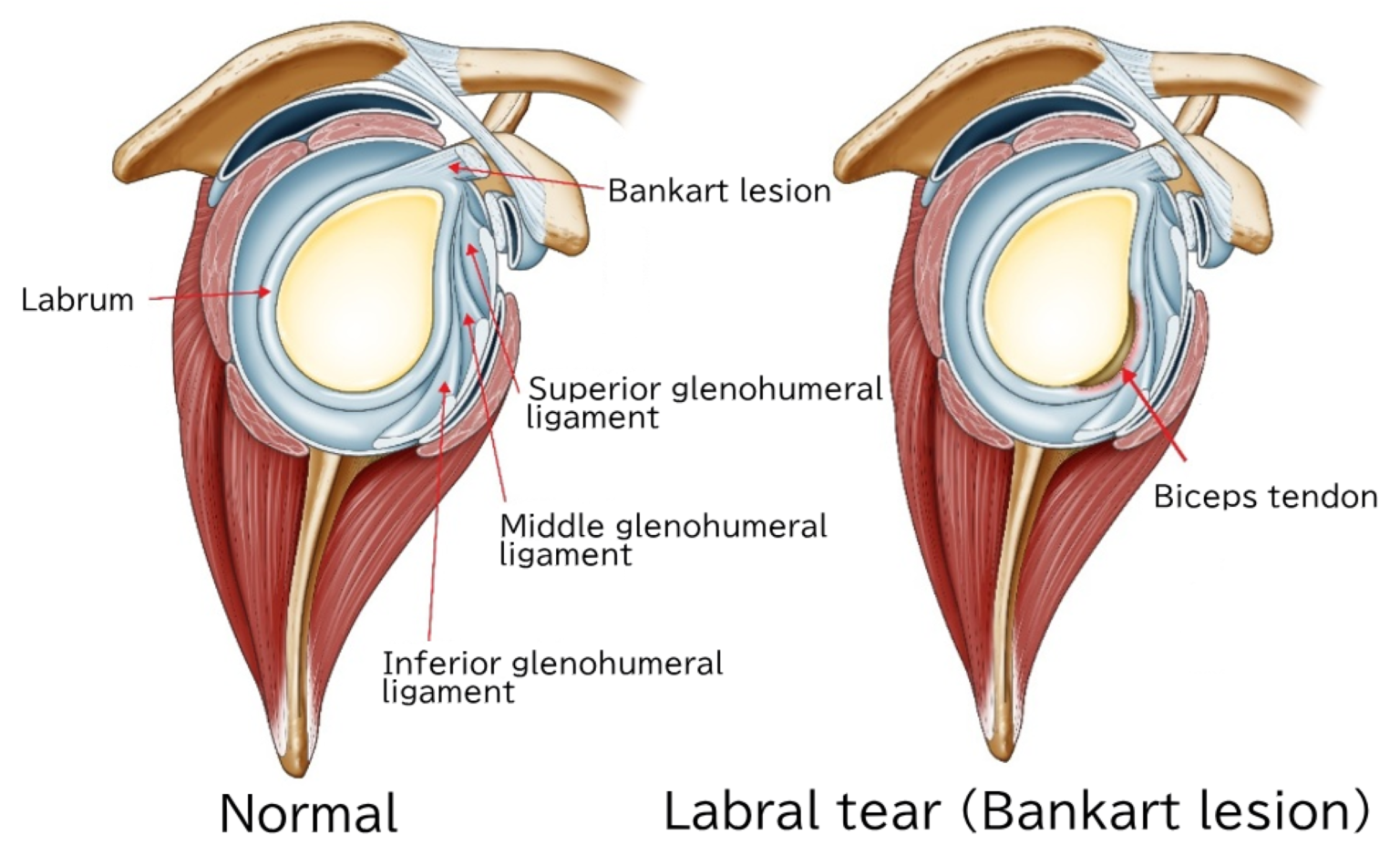 SURGERY FOR RECURRENT SHOULDER DISLOCATION | MEDICAL INFO | Kyoto ...