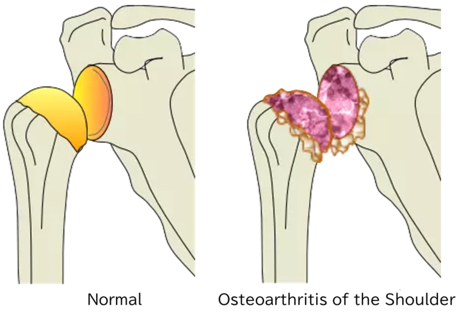 OSTEOARTHRITIS OF THE SHOULDER | MEDICAL INFO | Kyoto Shoulder & Sports ...