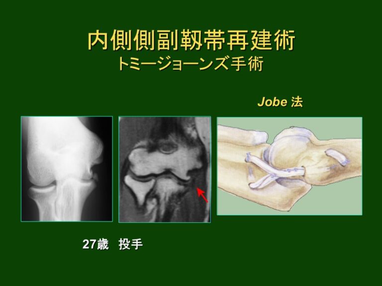 ULNAR COLLATERAL LIGAMENT INJURY | MEDICAL INFO | Kyoto Shoulder ...