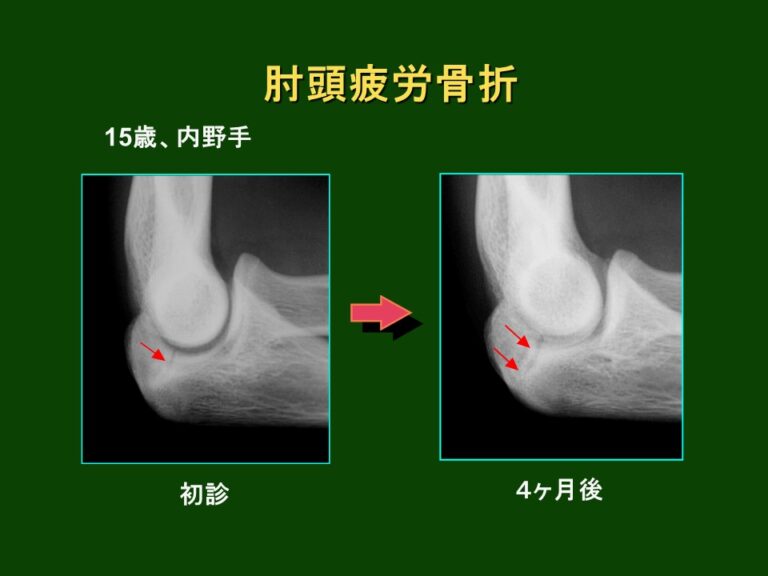 OLECRANON STRESS FRACTURE | MEDICAL INFO | Kyoto Shoulder & Sports ...